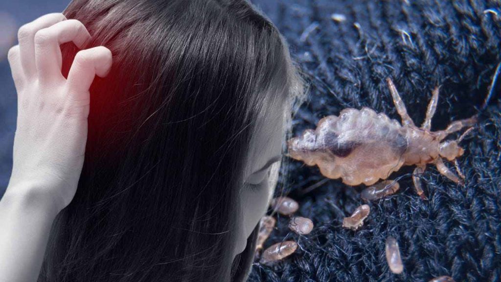 Pidocchi, il rimedio naturale per mandarli via una volta per tutte: è ...