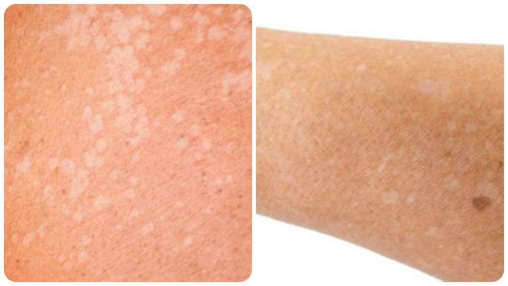 Sai cosa sono quelle piccole macchie bianche sulla pelle? Ecco il loro ...